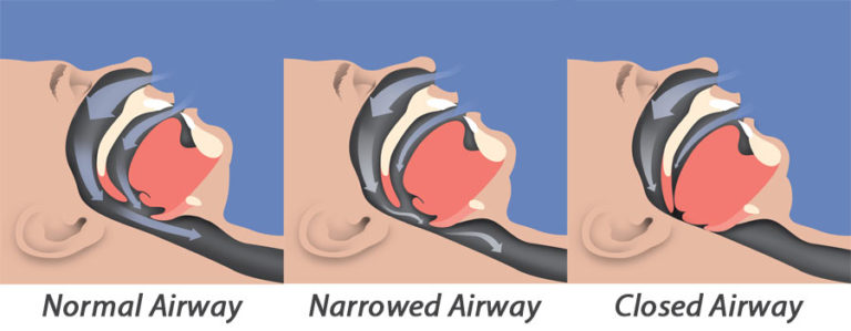 Sleep Apnea in Plano - Plano Gentle Dental - Sleep Apnea Treatment
